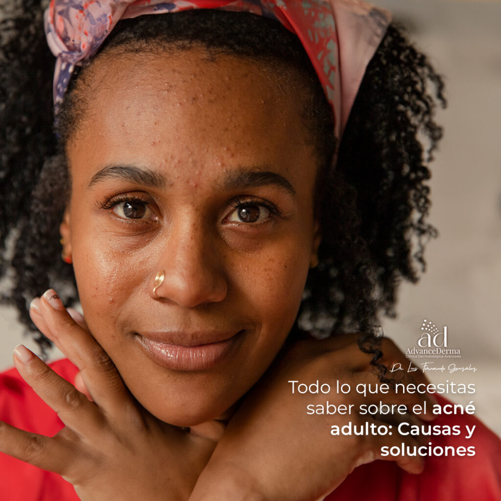 Todo lo que necesitas saber sobre el acné adulto: Causas y soluciones ...